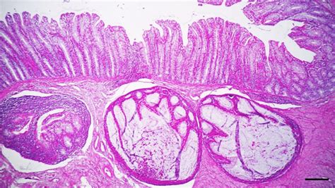 Ileum Cryptitis And Herniation Of The Crypts Into The Submucosa The