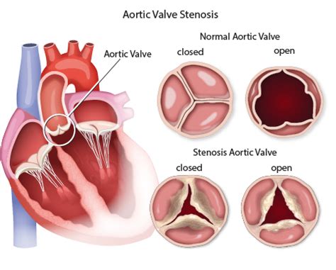 Aortic Stenosis Management Of Asymptomatic Severe Aortic Stenosis