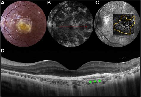 Macular Neovascularization In Choroideremia Ophthalmology Retina