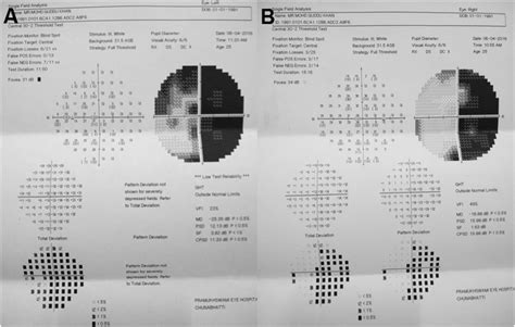 Computerized Perimetry A Left Eye B Right Eye Showing Left Sided