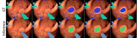 Example Of Sequential Endoscopy Artefact Image Segmentation And Download Scientific Diagram