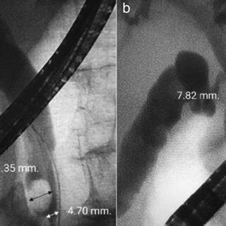 Cholangiography And Measurement Of Stone Black Arrow And Distal CBD Download Scientific