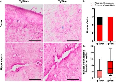Hemosiderin Prussian Blue What To Know About Hemosiderin Staining