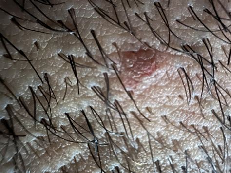 Genital Warts Rdermatologyquestions