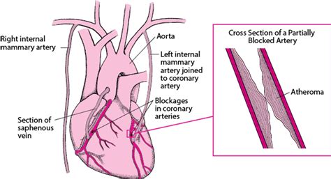 Imagecoronary Artery Bypass Grafting Merck Manual Consumer Version