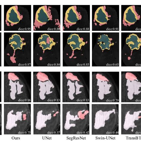 quantitative comparison on brats 2020 dataset download scientific