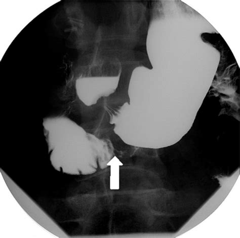 Contrast Study Before Surgery Demonstrating Dilated Proximal Duodenum