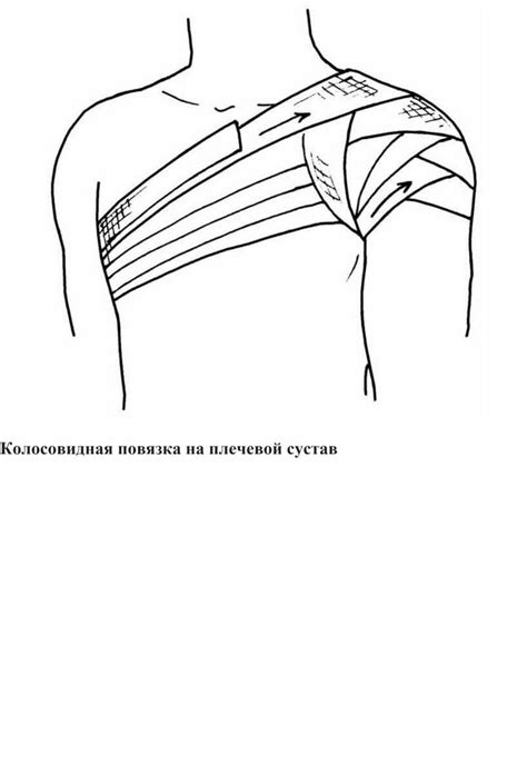 Типы бинтовых повязок