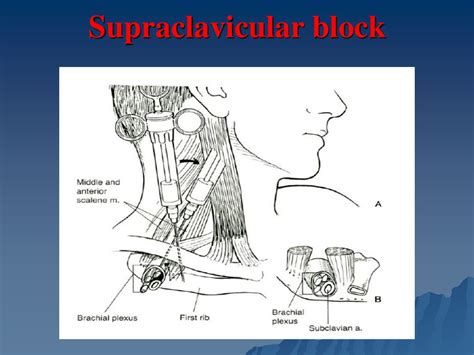 Periferal Nerve Blocks Ppt Download