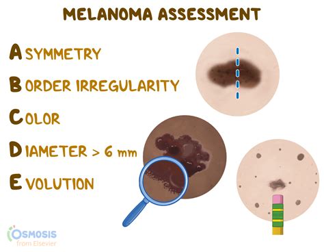Abcde Melanoma Assessment Mnemonic Osmosis