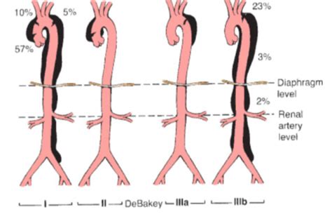 Thoracic Ao Surgery Qs Flashcards Quizlet