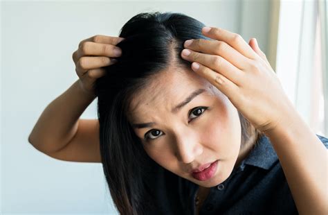 Oily Scalp Hair Loss Yun Nam Hair Care