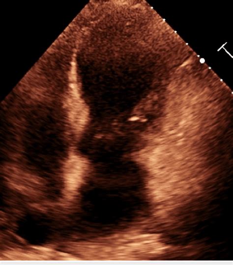 2d Echocardiogram After The Development Of Tcm Note The Characteristic Download Scientific