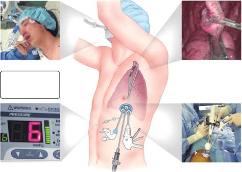 Operative Setting And Procedures For Single Port Thoracoscopic Bleb Download Scientific Diagram