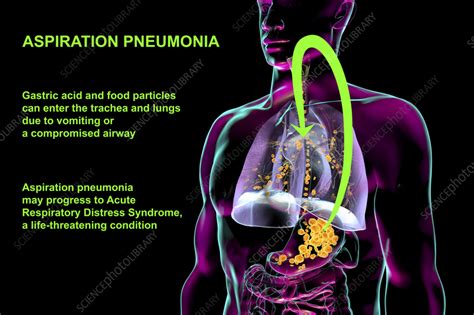 Aspiration Pneumonia Illustration Stock Image F0442674 Science