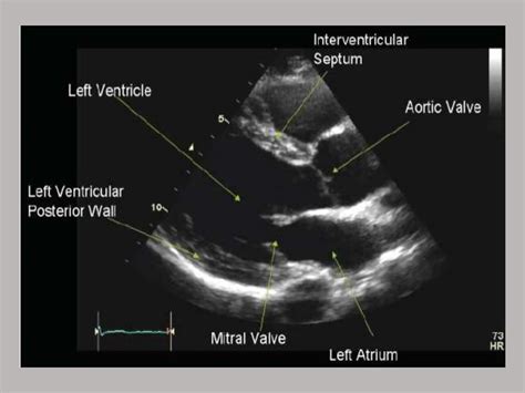 How To Read Echocardiography Of Heart Pptx