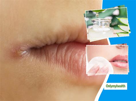 Achieving Quick Relief Overnight Cure For Angular Cheilitis Flash Uganda Media