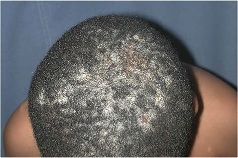 Scalp Infection Inflammation And Infestation Dermatologic Clinics