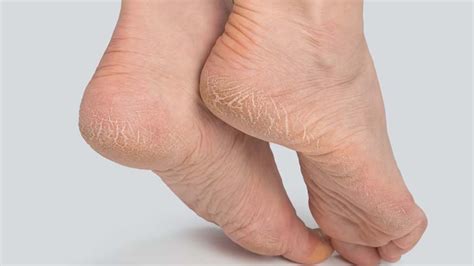 What Causes Cracked Heels