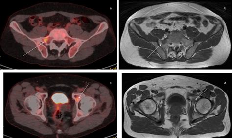 Distant Metastatic Disease At Presentation In A 57 Year Old Male With