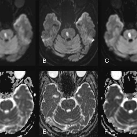 Apparent Diffusion Coefficient Dependency On Diffusion Time Download Scientific Diagram