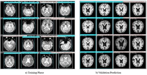 Automated Detection And Spatial Localization Of Alzheimers Disease