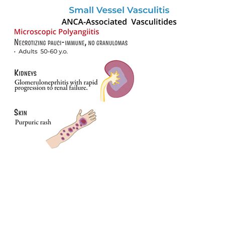 Clinical Pathology Glossary Vasculitis Small Vessels Ditki Medical