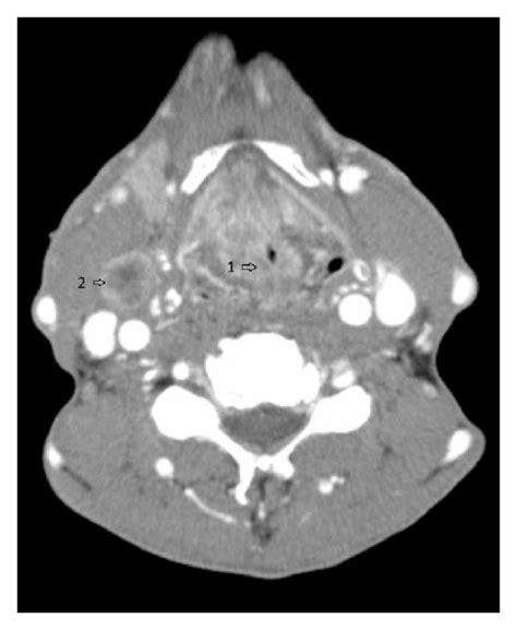 Supraglottic Level Ct Showing Airway Narrowed By Glottis Mass 1 And