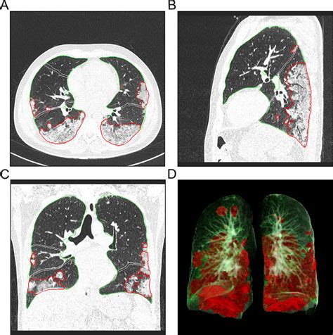 Flow Chart Of Patient Inclusion Figure 2 A C Ct Images Showing