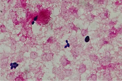 Gram Stain Of Blood Revealed Two Kinds Of Yeasts Of Different Sizes