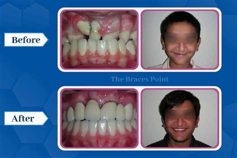 Braces For Cleft Lip And Palate Patients In Mumbai