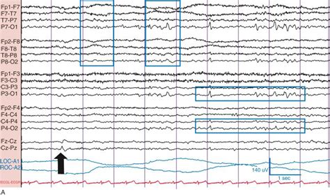 The Normal Adult EEG Clinical Tree
