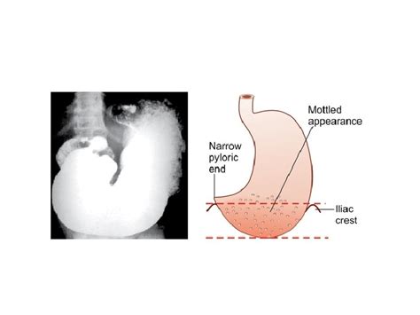 Vagotomy Types Of Vagotomy A Highly Selective Vagotomy