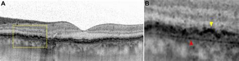 Oct B Scan Of A Dtga Patient Showing A A Diffuse Splitting Of The
