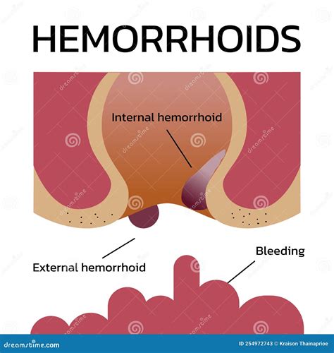Internal And External Hemorrhoids With Bleeding Infographic Stock