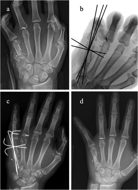 Metacarpal Fractures Alex G Lambi Robert J Rowland Nicholas W