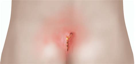 Sacral Dimple In Adults