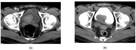 Imaging Of Bladder Cancer Standard Applications And Future Trends