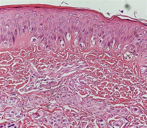 Histologia Do Nevo Epidermico