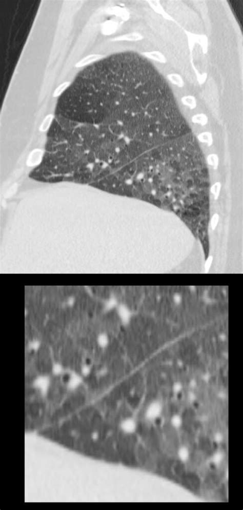 253Lu DIP Desquamative Interstitial Pneumonia Lungs