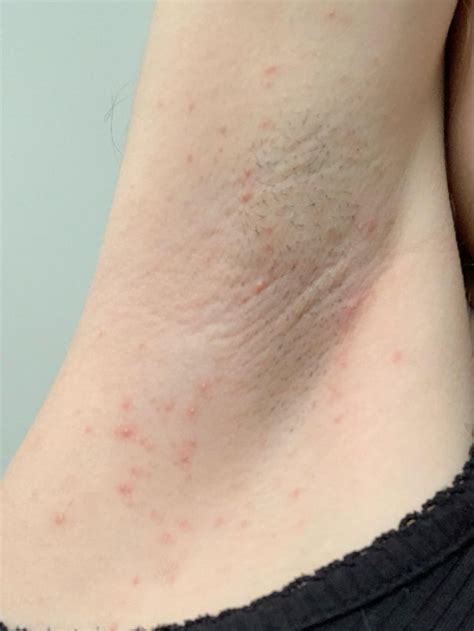 Underarm Rash Using Any Roll On Deodorant R Hyperhidrosis