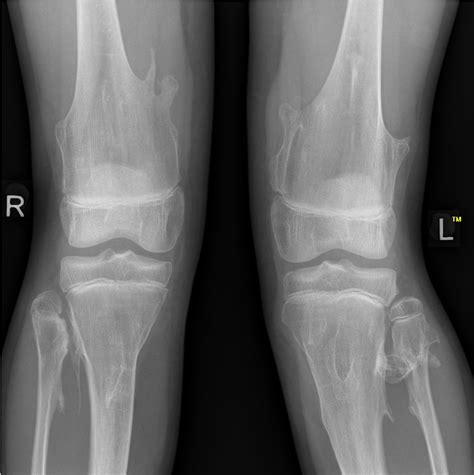 Multiple Hereditary Exostosis The Bone School