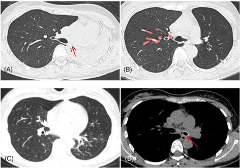 Application Of Bronchoscopic Transparenchymal Nodule Access In
