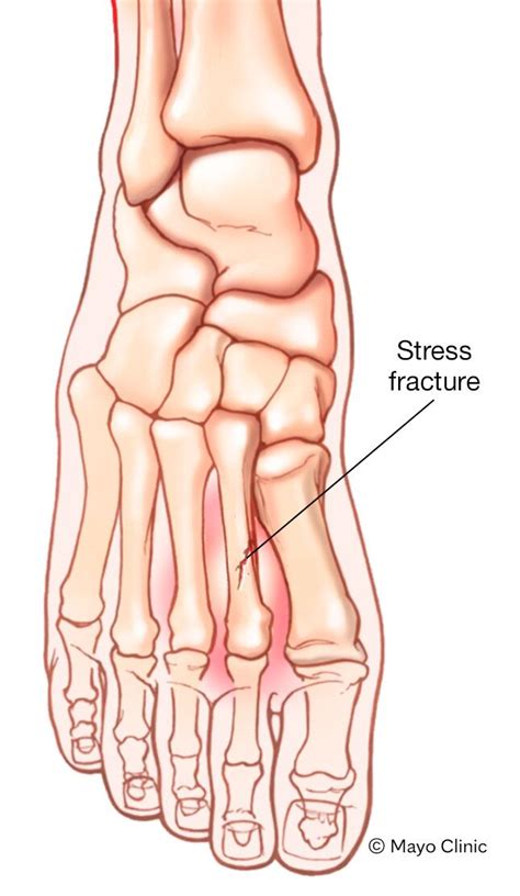 A Hairline Fracture And A Stress Fracture Are The Same 49 Off
