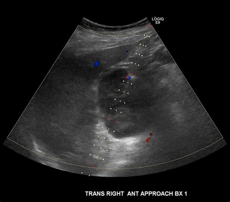 Radiopaedia Case Ivc Leiomyosarcoma Id 81086 Study 94849 Nc Commons