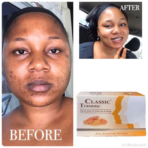 Classic Tumeric Soap Tumericsoap2021 • Instagram Photos And Videos