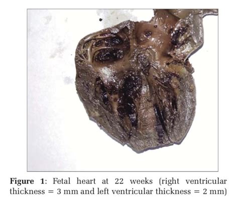 Assessment Of Fetal Left And Right Ventricular Thickness And Its