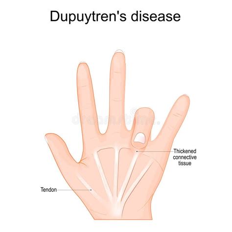 Dupuytrens Contracture Is A Condition In Which Fibrotic Tissue And Collagen Accumulate In The
