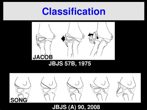 Lateral Condylar Fractures Ppt Download