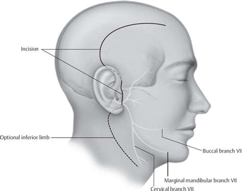 The Preauricular Infratemporal Approach Neupsy Key